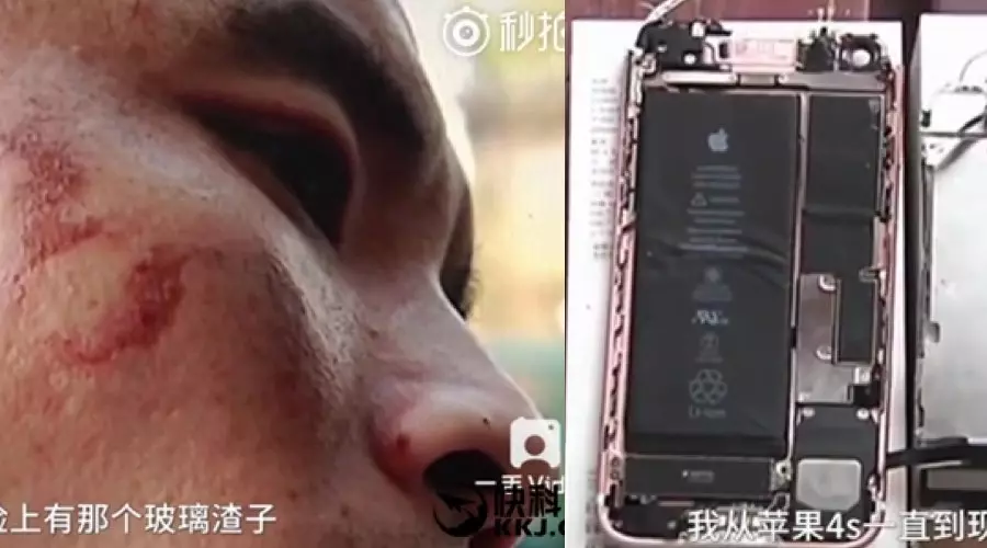 Apple iPhone 7 explodéiert op d'Gesiicht vum Mann beim Videoopnam